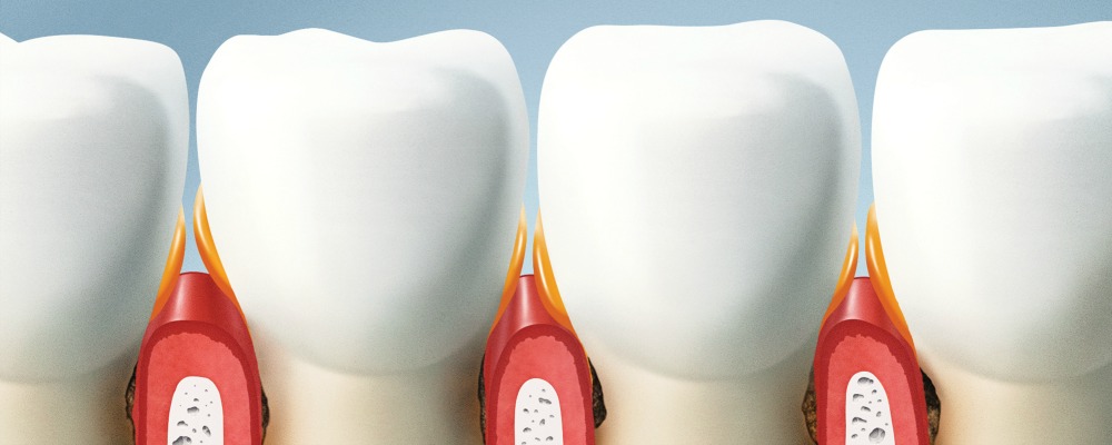 Penyebab Gusi Menjadi Putih "Pucat"